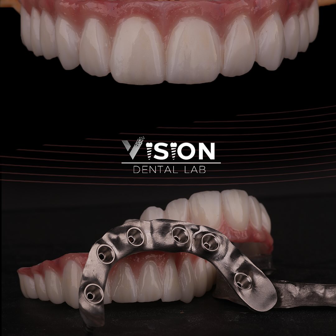 Implant Solutions – Vision Dental Laboratory