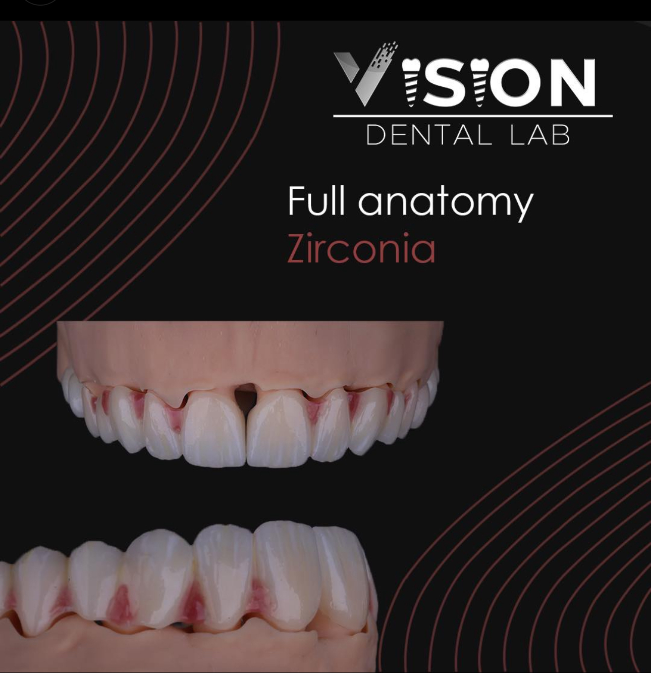 Smile Design and Crowns – Vision Dental Laboratory