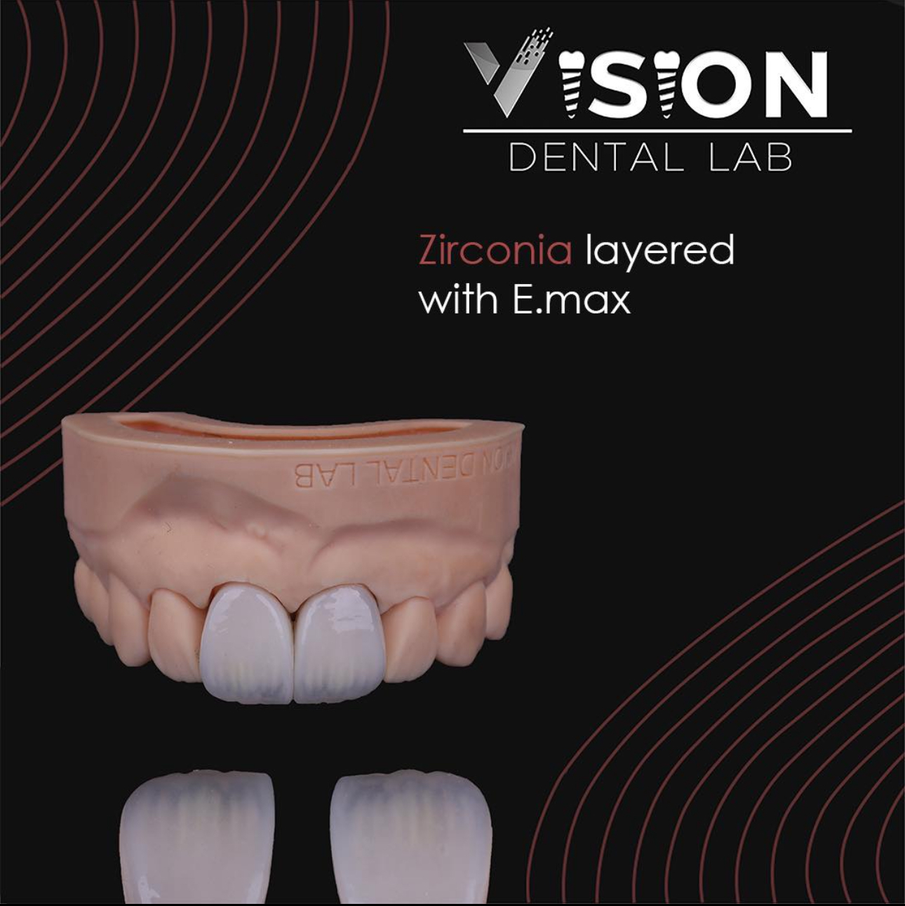 Smile Design and Crowns – Vision Dental Laboratory