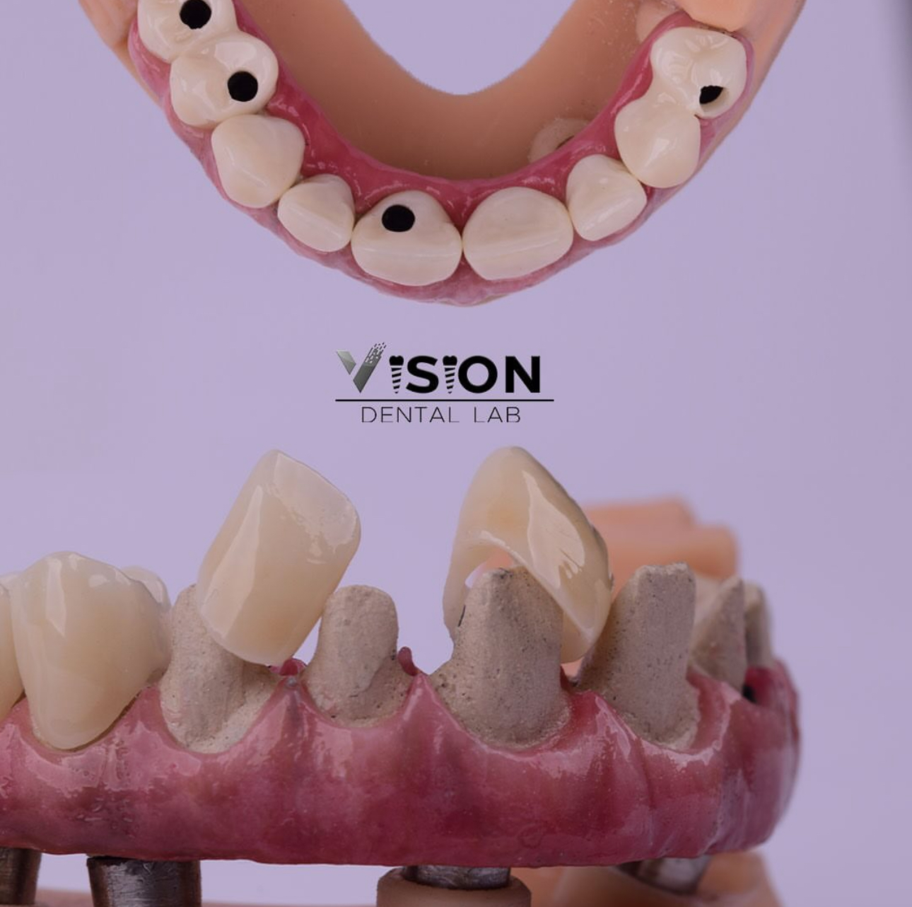 Implant Solutions – Vision Dental Laboratory