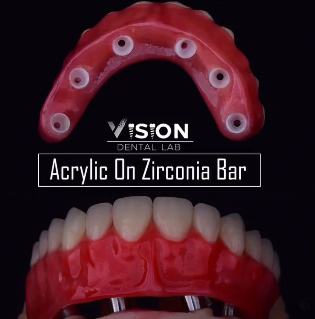 Implant Solutions – Vision Dental Laboratory