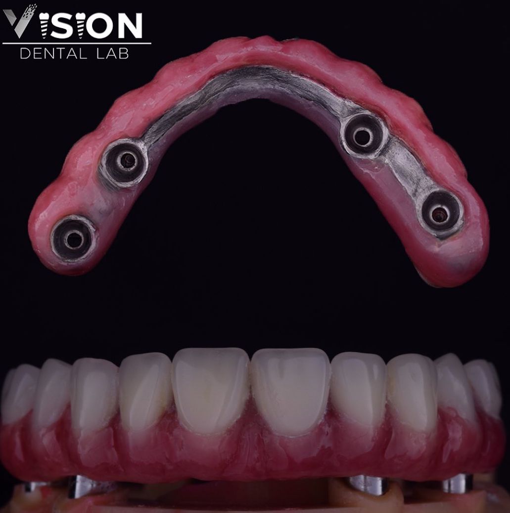 Implant Solutions – Vision Dental Laboratory